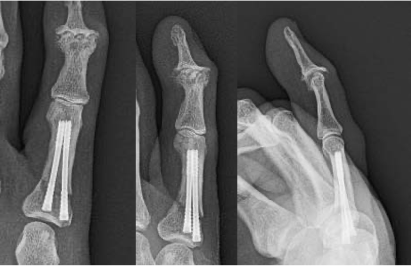 Use of the NX Nail Fixation of Angulated P1 Base Fracture